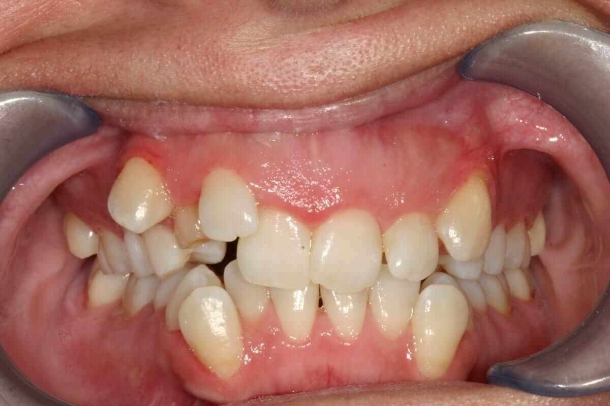 Dientes torcidos.¿Soluciones? - Clínica Birbe