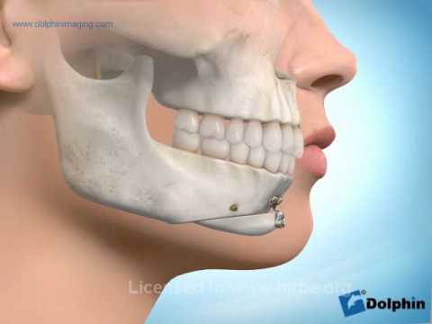 Mentoplastia | Cirugía del mentón en clínica B I R B E
