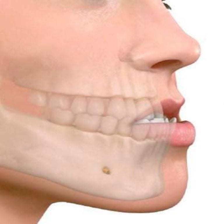 Retrognatia Mandibular - Clínica Birbe