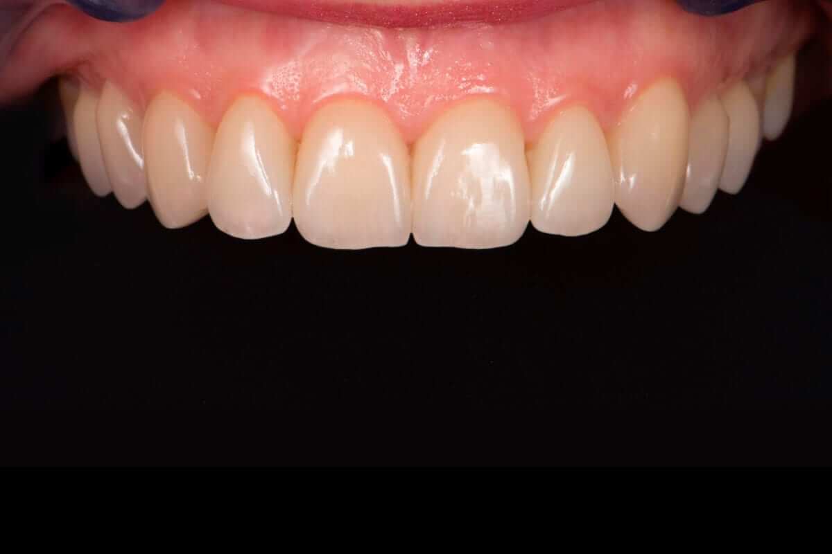 ¿Hongos en la boca? Candidiasis oral - Clínica Birbe