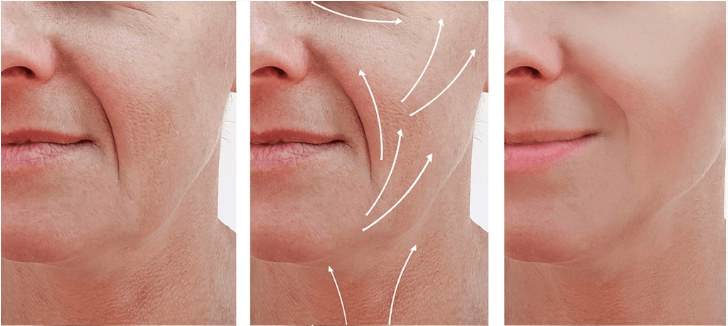 Precio de un lifting facial - Clínica Birbe