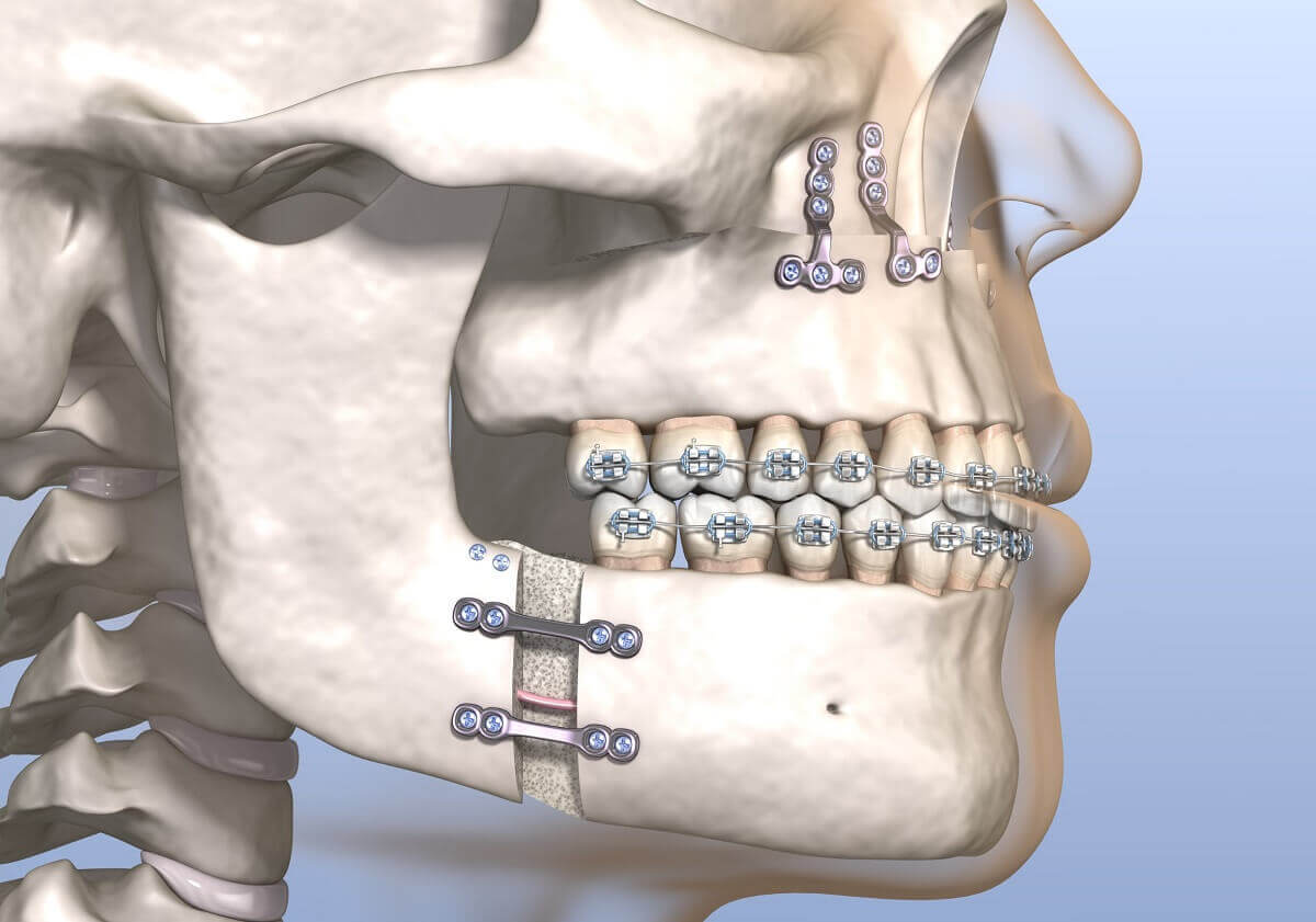 Maloclusiones y análisis facial - Clínica Birbe